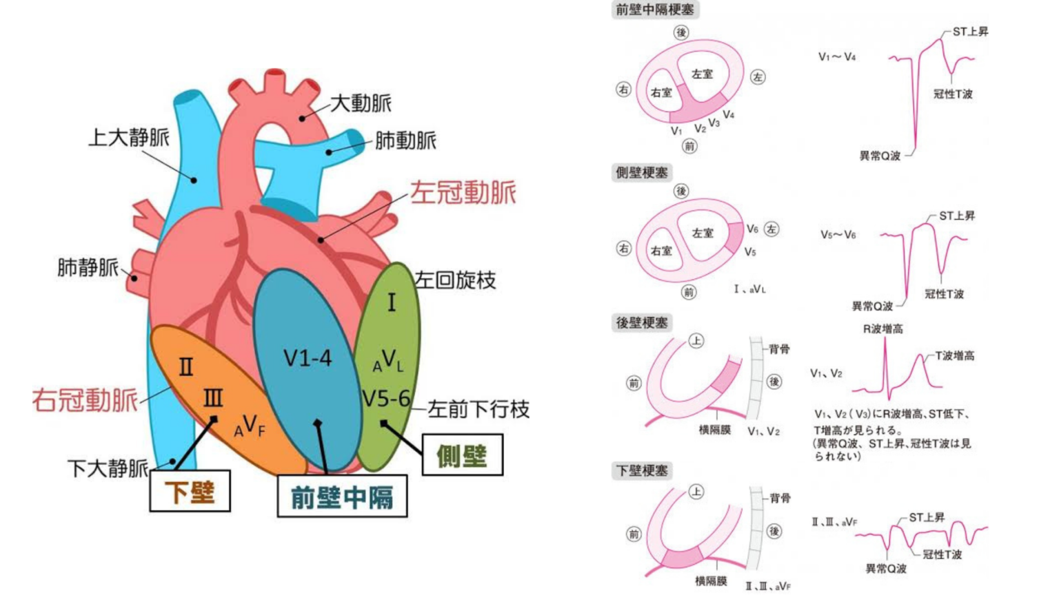 心筋梗塞の部位ごとの梗塞について解説｜救急救命士が心電図から処置を選択 | 救急救命士キャリアップデート